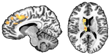 Severe irritability in children and teens: A new understanding